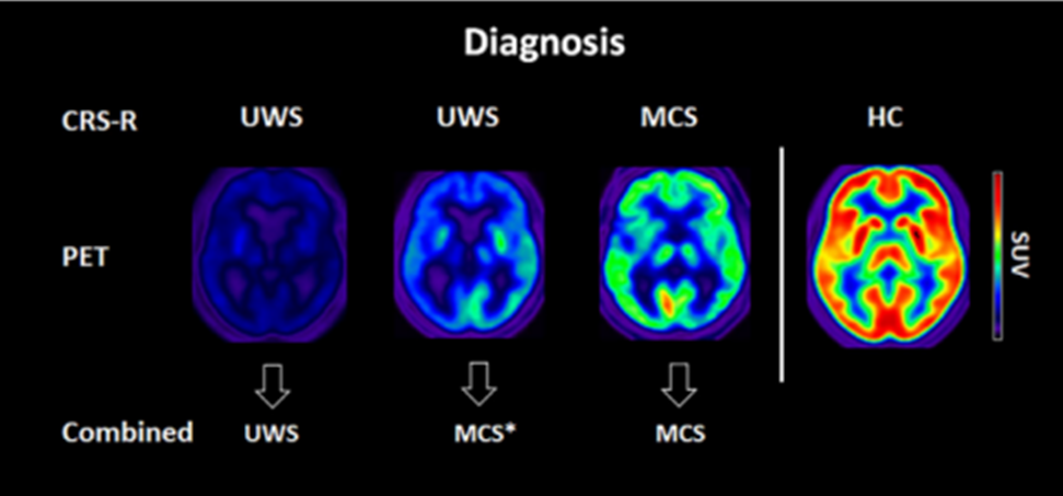 行为无反应患者大脑活动有助于识别MCS患者-千蝶医学
