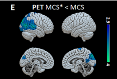 行为无反应患者大脑活动有助于识别MCS患者-千蝶医学